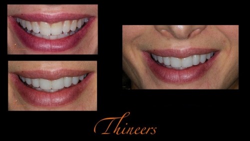 Thineers