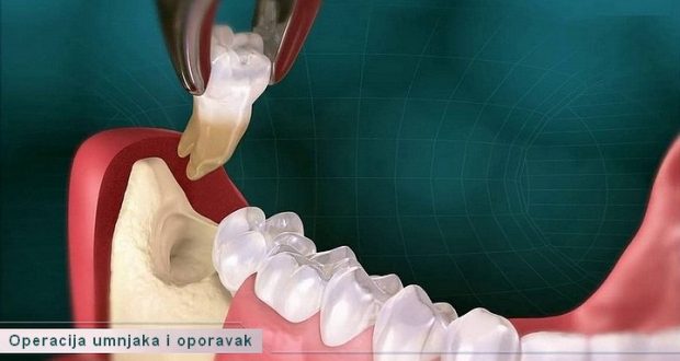 Operacija umnjaka i oporavak